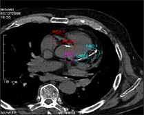 Calcium screening of coronary arteries